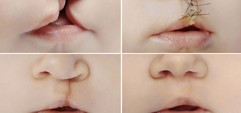 Lippen-Kiefer-Gaumenspalte/LKG - Universitätsklinik für Kinderchirurgie ...